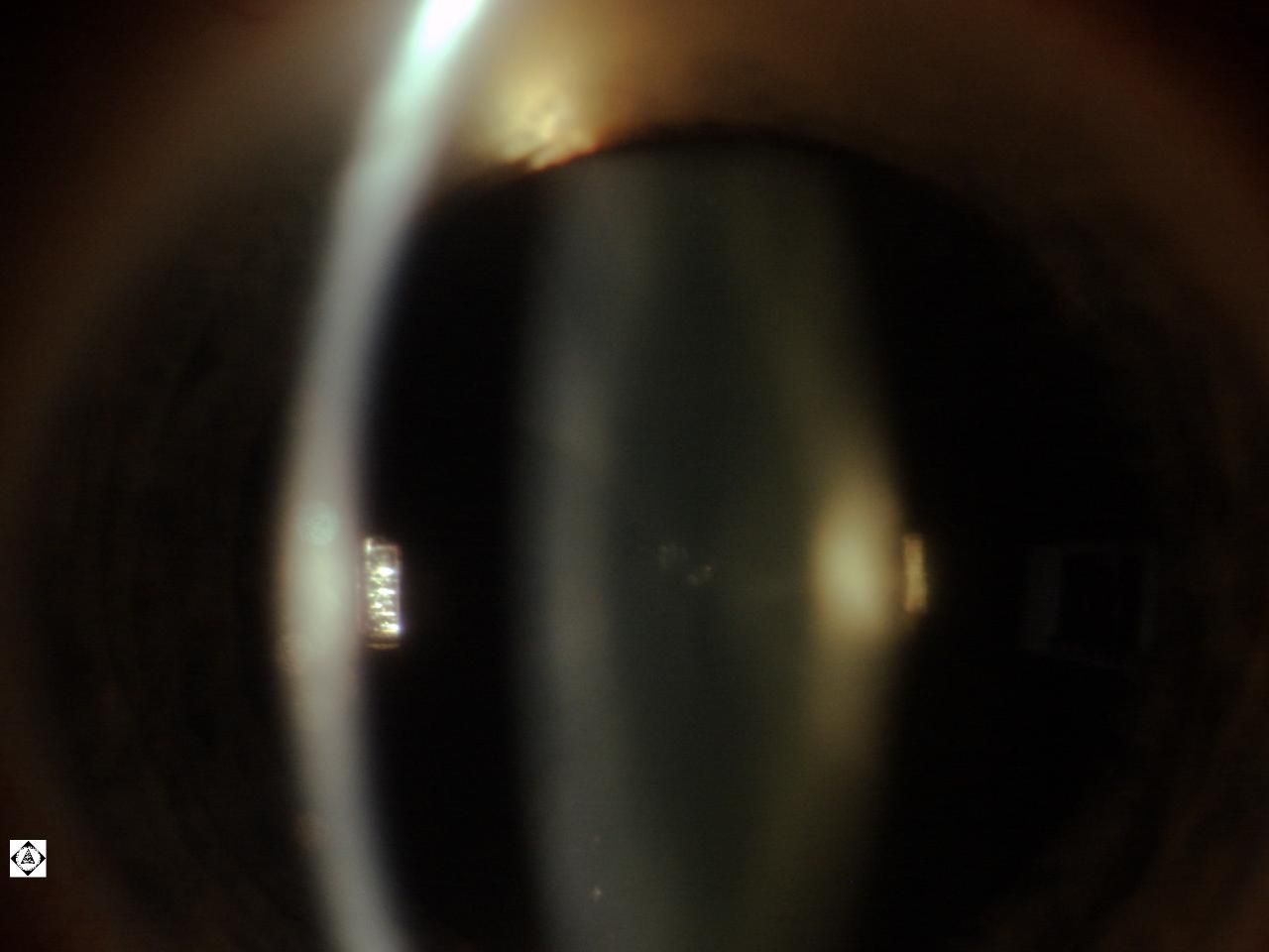 Sonoran Desert Eye Center: CONGENITAL LENS OPACITIES