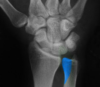 OSSA CARPALIA ©: octubre 2011