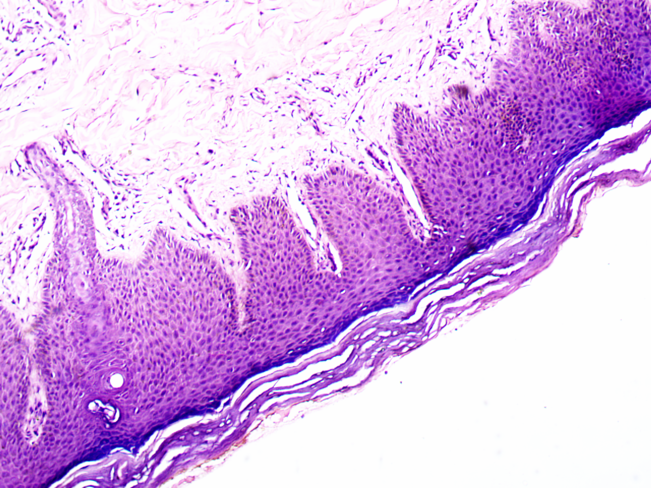 into the roots: Psoriasiform reaction pattern