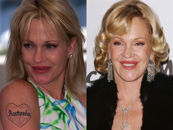 Melanie Griffith Surgery