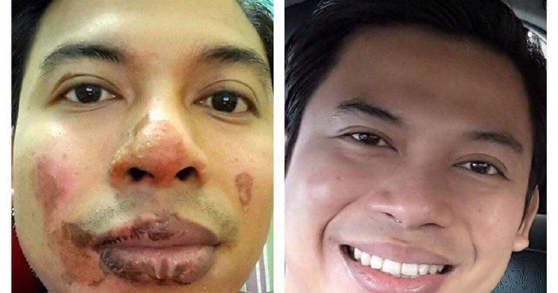 CARA HILANGKAN PARUT KULIT TERBAKAR AKIBAT TERKENA API