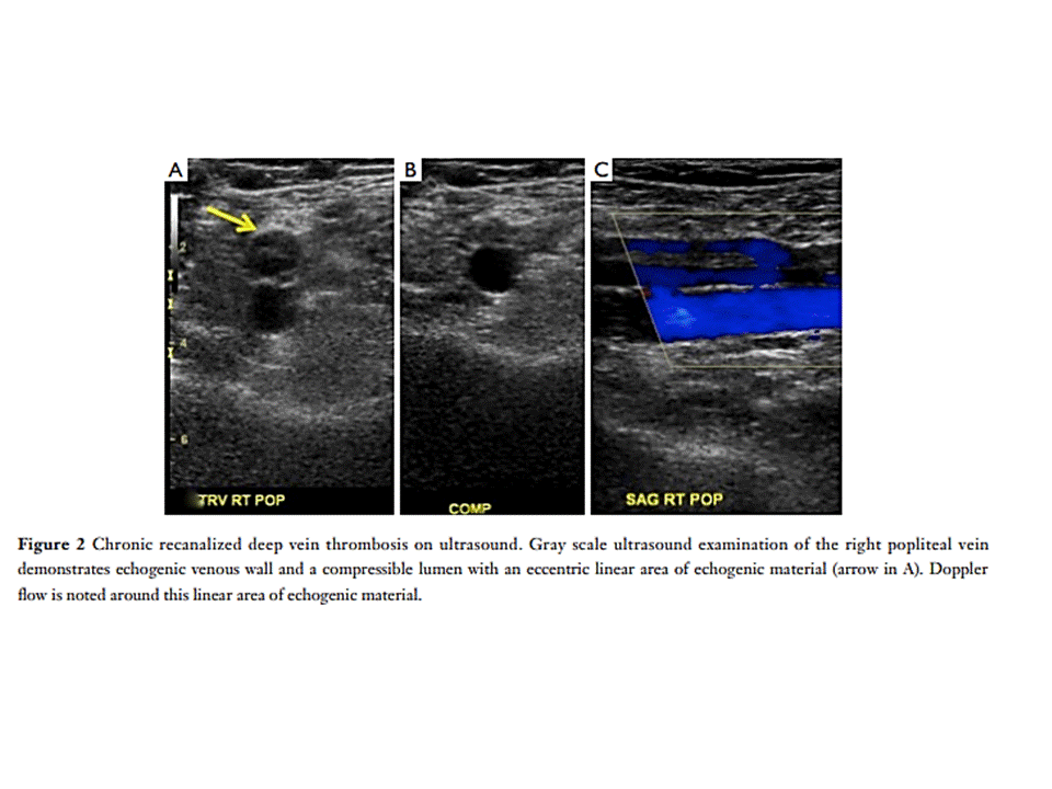 BÀI SOẠN VỀ SIÊU ÂM CHẨN ĐOÁN: Acute and Chronic DVT and Ultrasound (US)