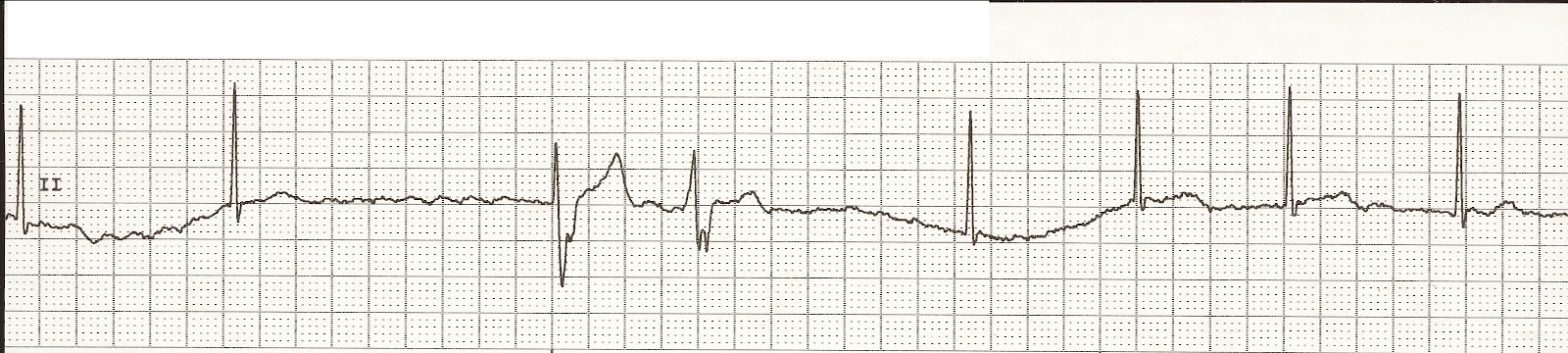 EKG Rhythm Strip Quiz 2