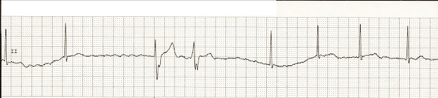 EKG Rhythm Strip Quiz 2