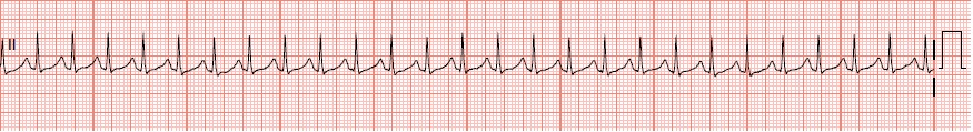 EKG Rhythm Strips 16: Atrial Rhythms