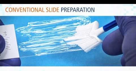 Klinik Putra Pokok Sena: Ujian Pap Smear BD SurePath Mengesan Kanser ...