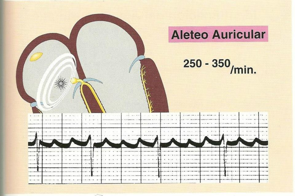 Dr. Rafael Soto - Electrocardiografía - Cardiología clínica: Aleteo ...