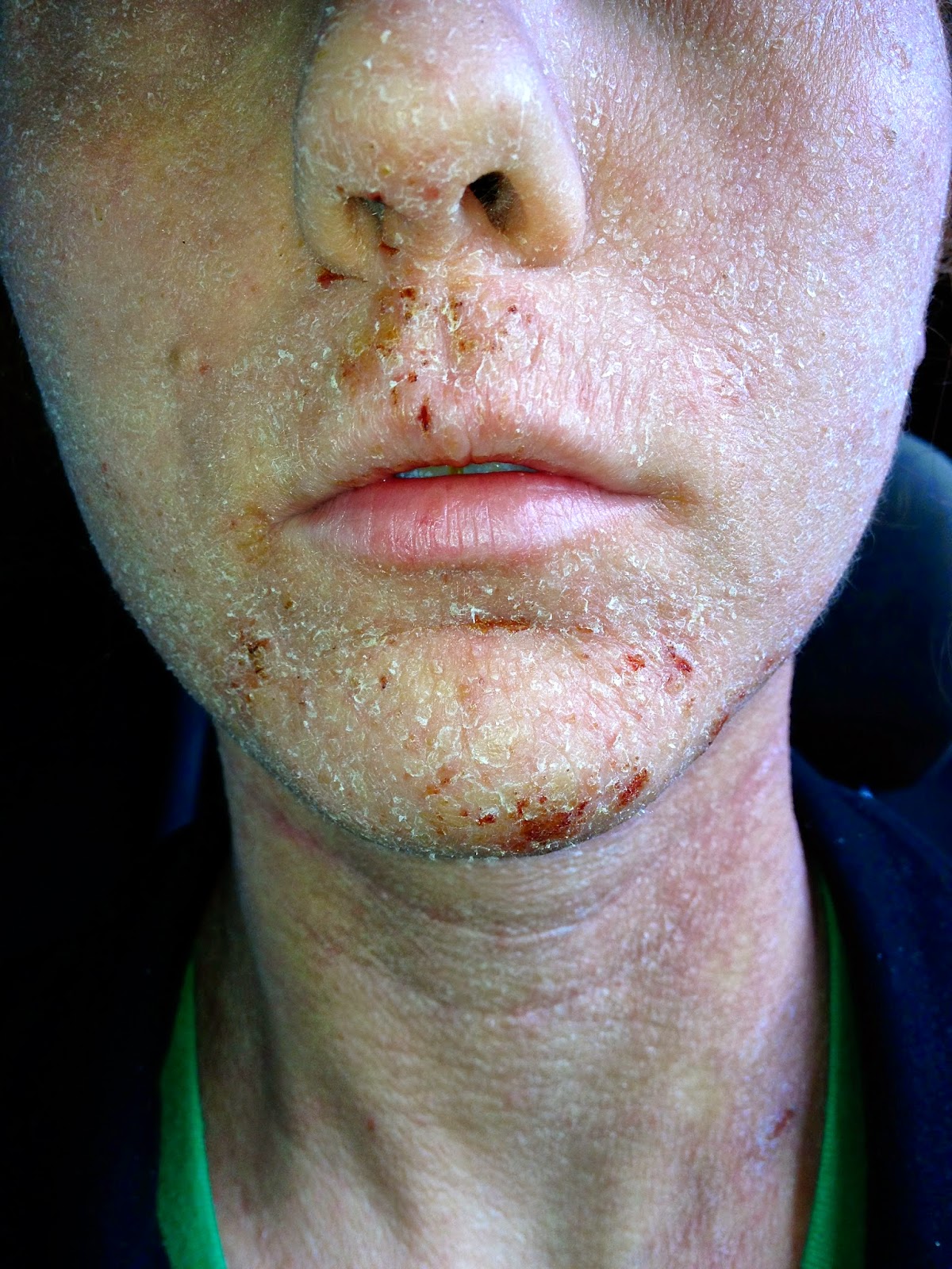 Scratching the Surface of Topical Steroid Withdrawal: Day 327- I Was Right