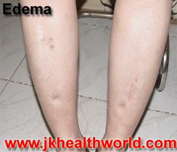 Healthadvice2day: Edema