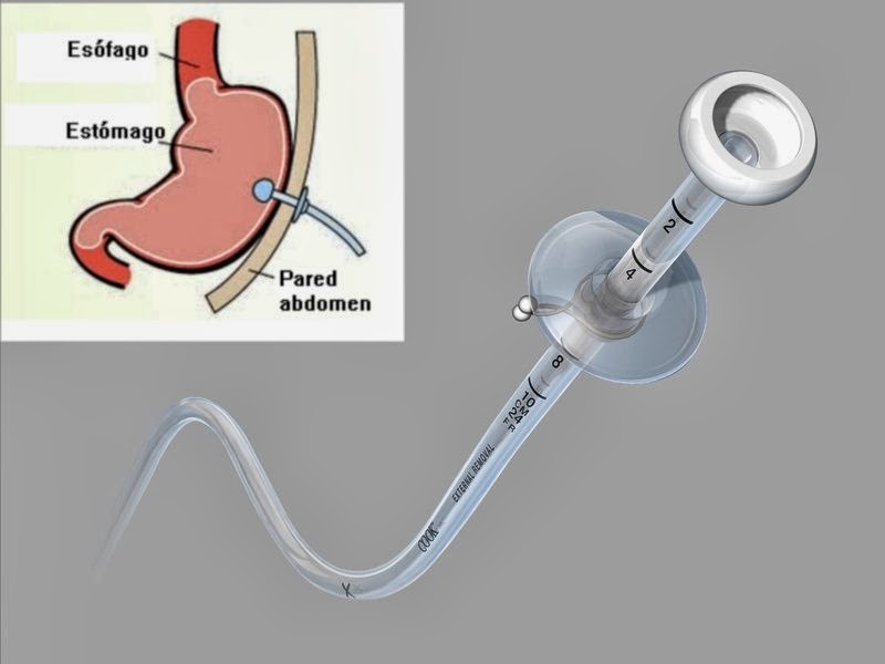 Gastrostomia Sonda