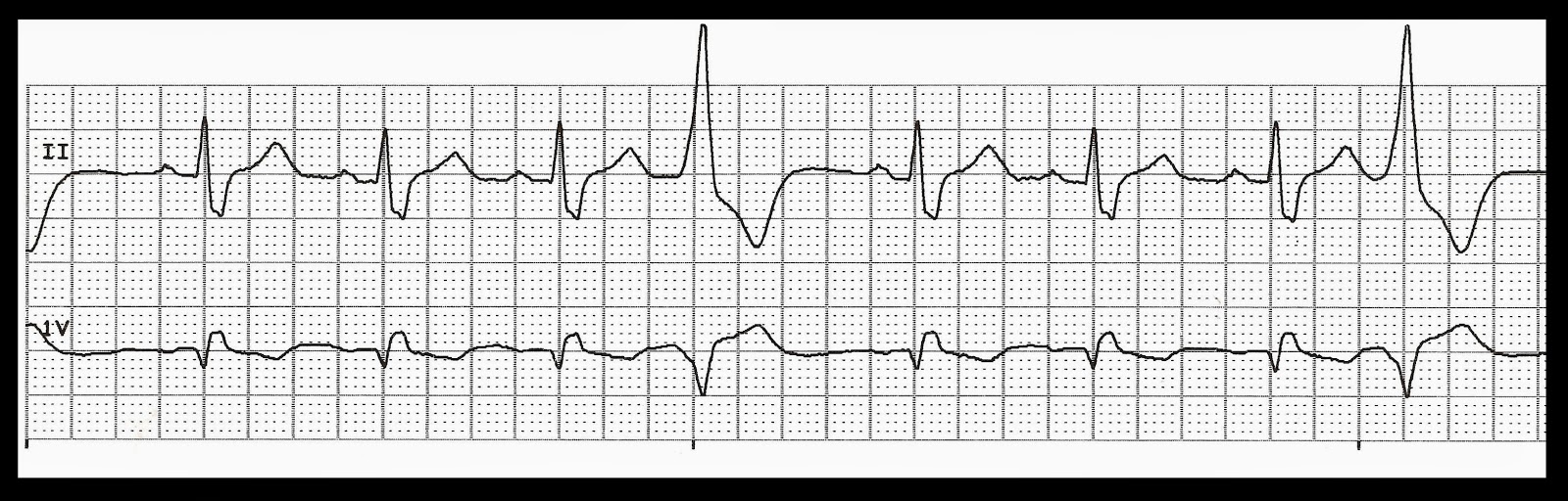 EKG Rhythm Quiz 274
