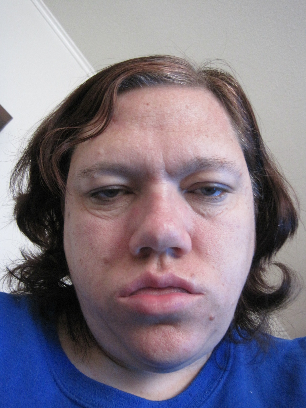 Life with Acromegaly: Breakthrough Symptoms....horrible reminders.