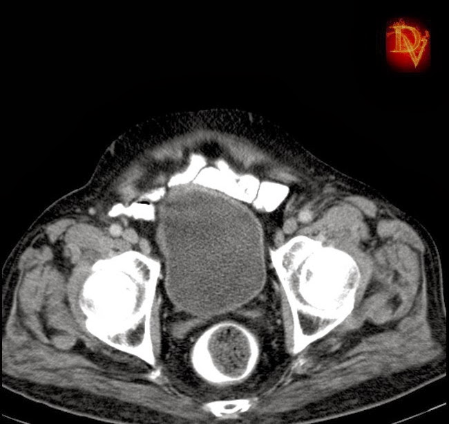 Ultimate Radiology : Urinary Bladder Herniation