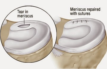 Medical Treatment Pictures-for Better Understanding: Laparoscopic ...