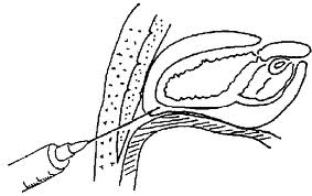 La ponction de péricarde ~ Santé et les soins infirmiers