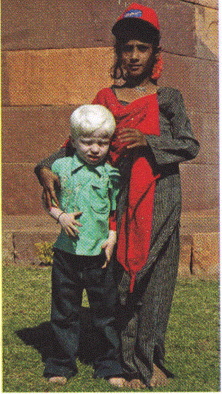 Kinds of Genetic Diseases - Some Genetic Disease - New Science Biology