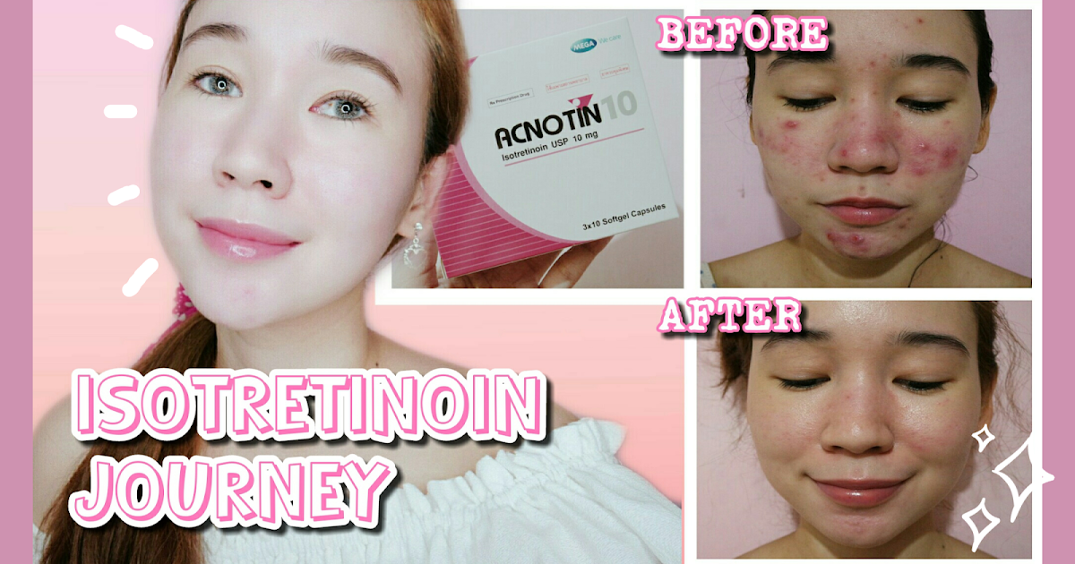 My ISOTRETINOIN JOURNEY (ACNOTIN/ACCUTANE) 6 MONTHS SKIN UPDATE