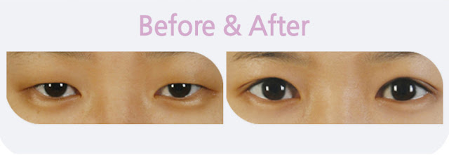 Eyelid Surgery Legend Dr. Kim Byung Gun: Types of Eyelid Surgery: What ...
