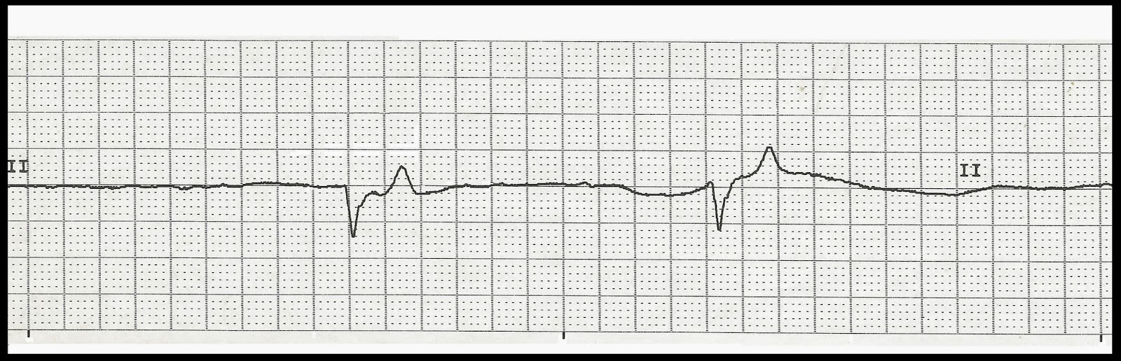 Practice EKG Rhythm Strips 229