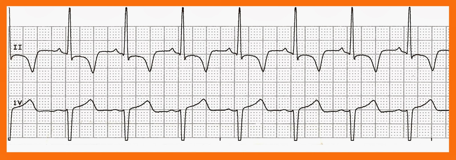 Various Normal Sinus Rhythms