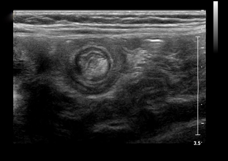 Jejunal intussusception-Ultrasound - Sumer's Radiology Blog