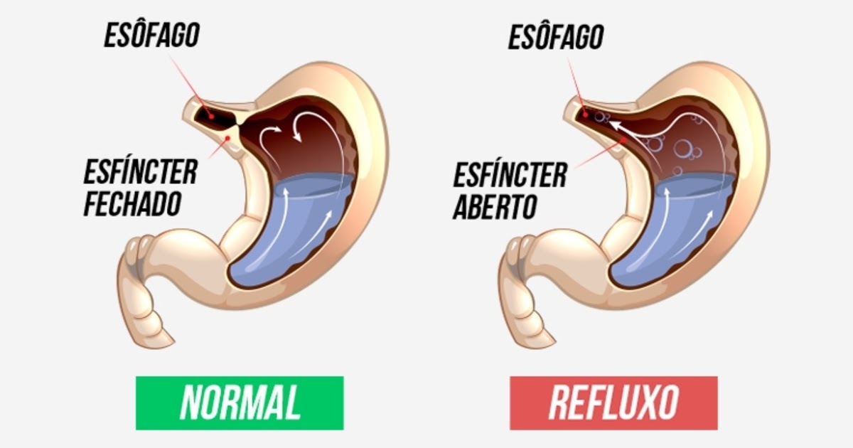 BenveNutri: Refluxo Gastroesofágico - Esofagite