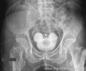 blog rAdiOlogii: VESICOLITHIASIS