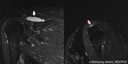 Roentgen Ray Reader: Intramuscular Cysts of the Rotator Cuff