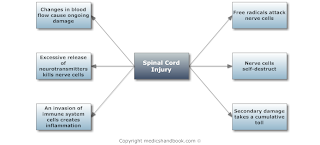 What Is Cortical Disruption