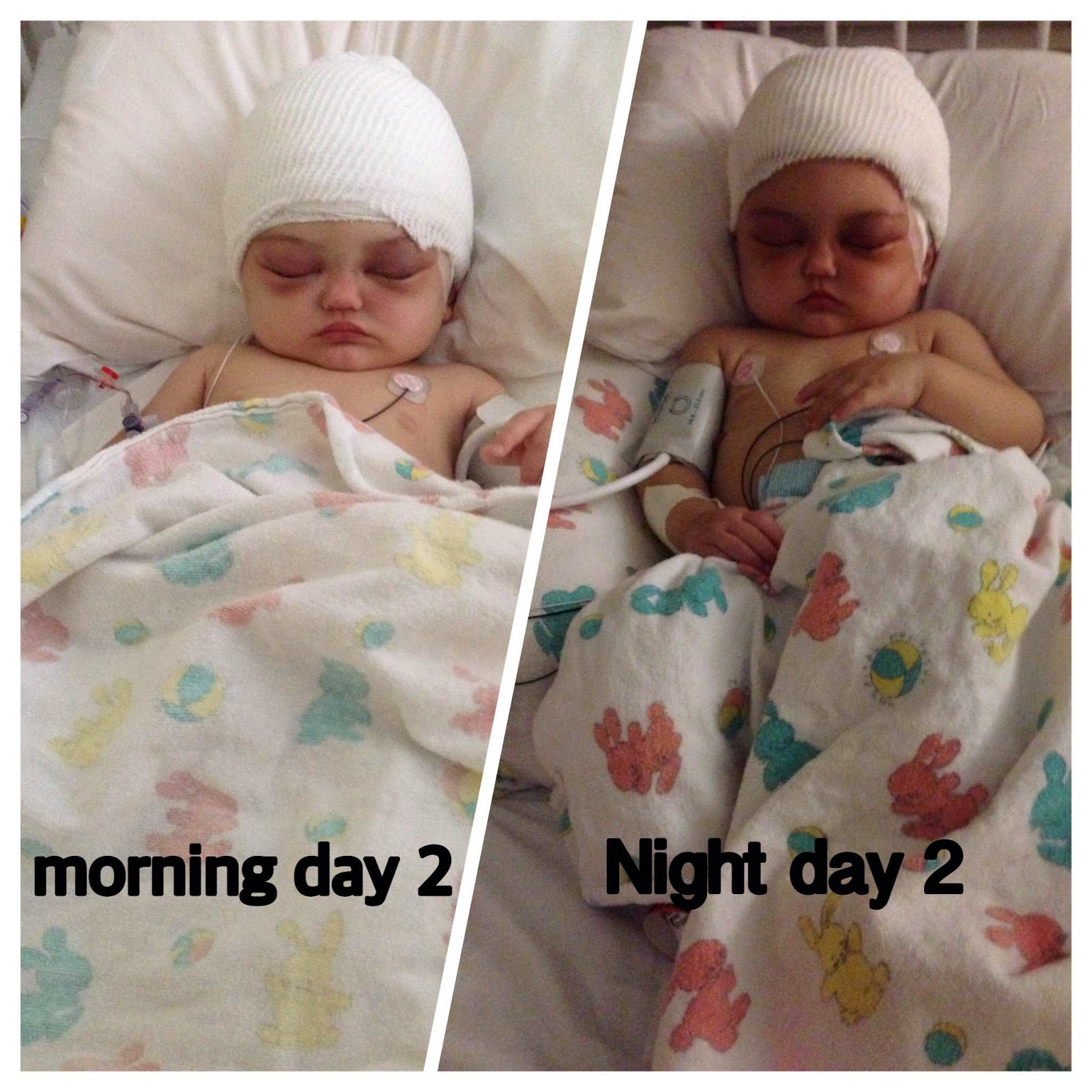 Rylen's Sagittal Cranial Vault Reconstruction Surgery Recap