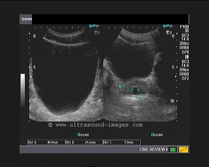 cochinblogs: Ultrasound study of a large prostate utricle cyst