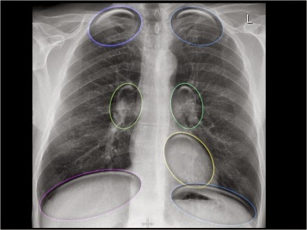 Chest Medicine Made Easy-Dr Deepu: Basics of Chest X Ray Part 3 ...