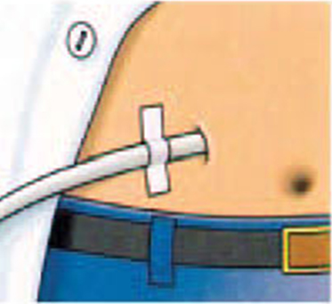 Renal Saúde: Diálise Peritoneal