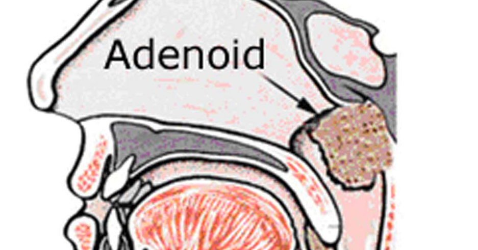 Swollen Adenoids