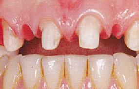 Dentistry lectures for MFDS/MJDF/NBDE/ORE: A note on Jacket crowns ...