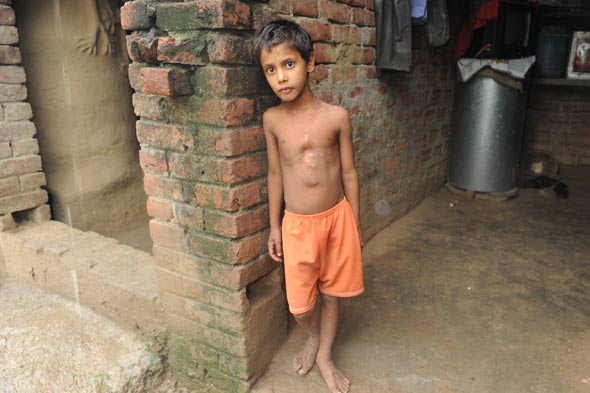 flesh eating bacteria: Eight limbed boy celebrating after surgery to ...