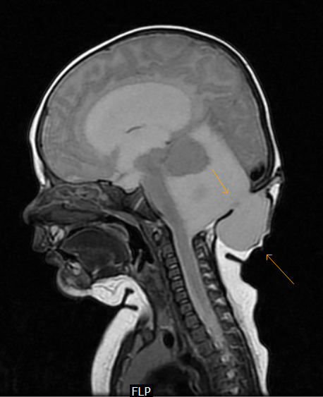 Rare Association of Dandy Walker malformation and Occipital Meningocele ...