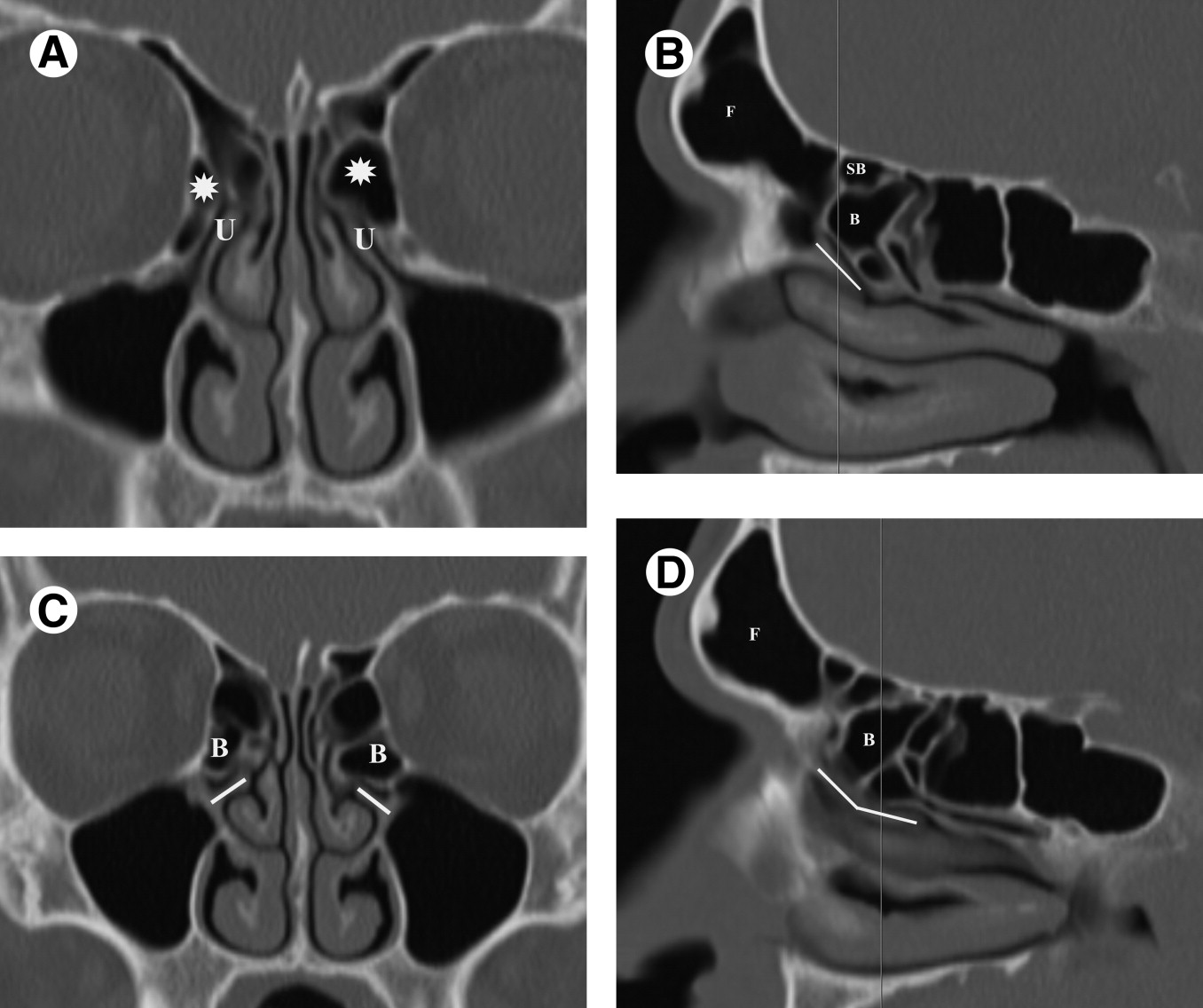 Auger Gear Image: Agger Nasi Cell Ct