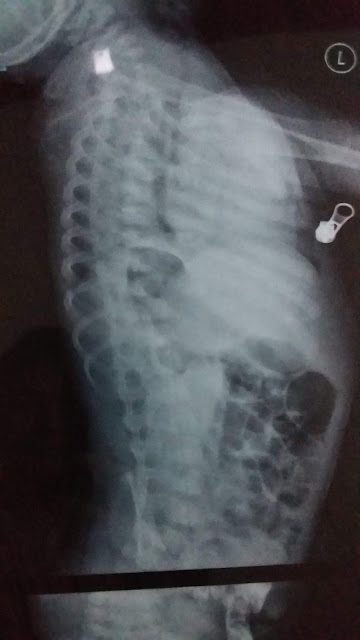 Contoh Laporan Hasil Radiologi Diagnosis TB Kelenjar pada Anak