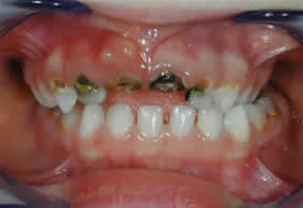 XTO 3D: SÍNDROME DEL BIBERÓN