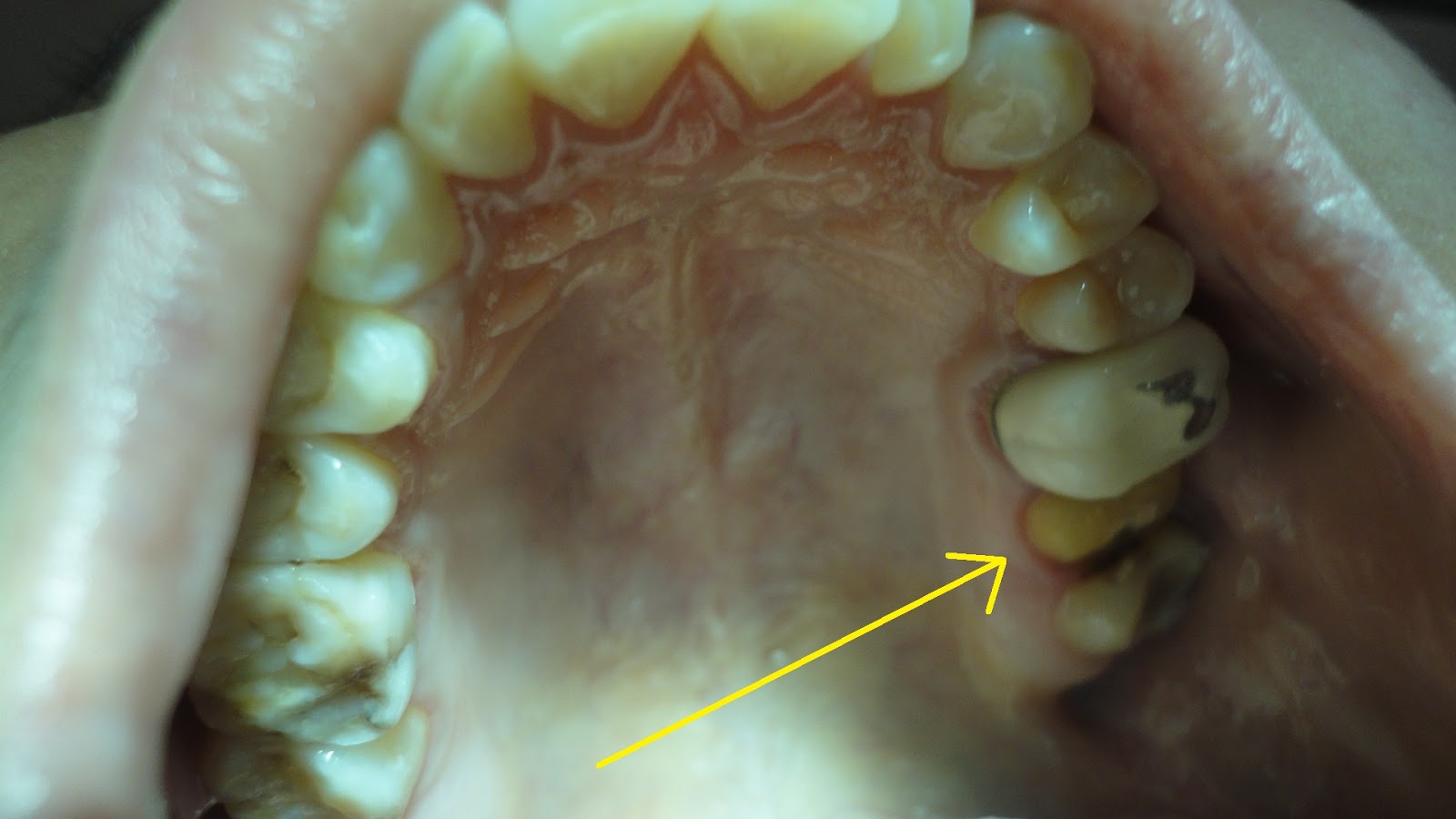 DR.BHAGYA'S DENTAL CARE AND IMPLANT CENTRE: ROOT CANAL WITH SINGLE ...