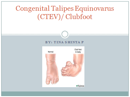 Congenital Talipes Equino Varus (CTEV) / Clubfoot