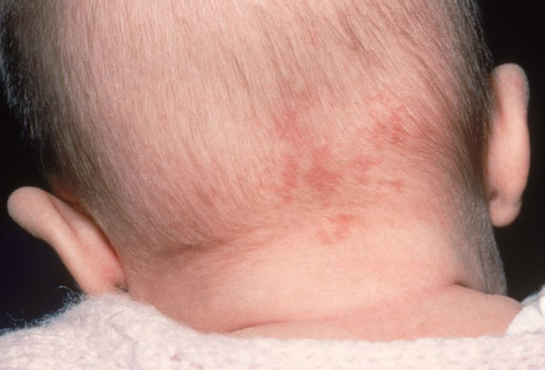 Healthy Life: Birthmarks