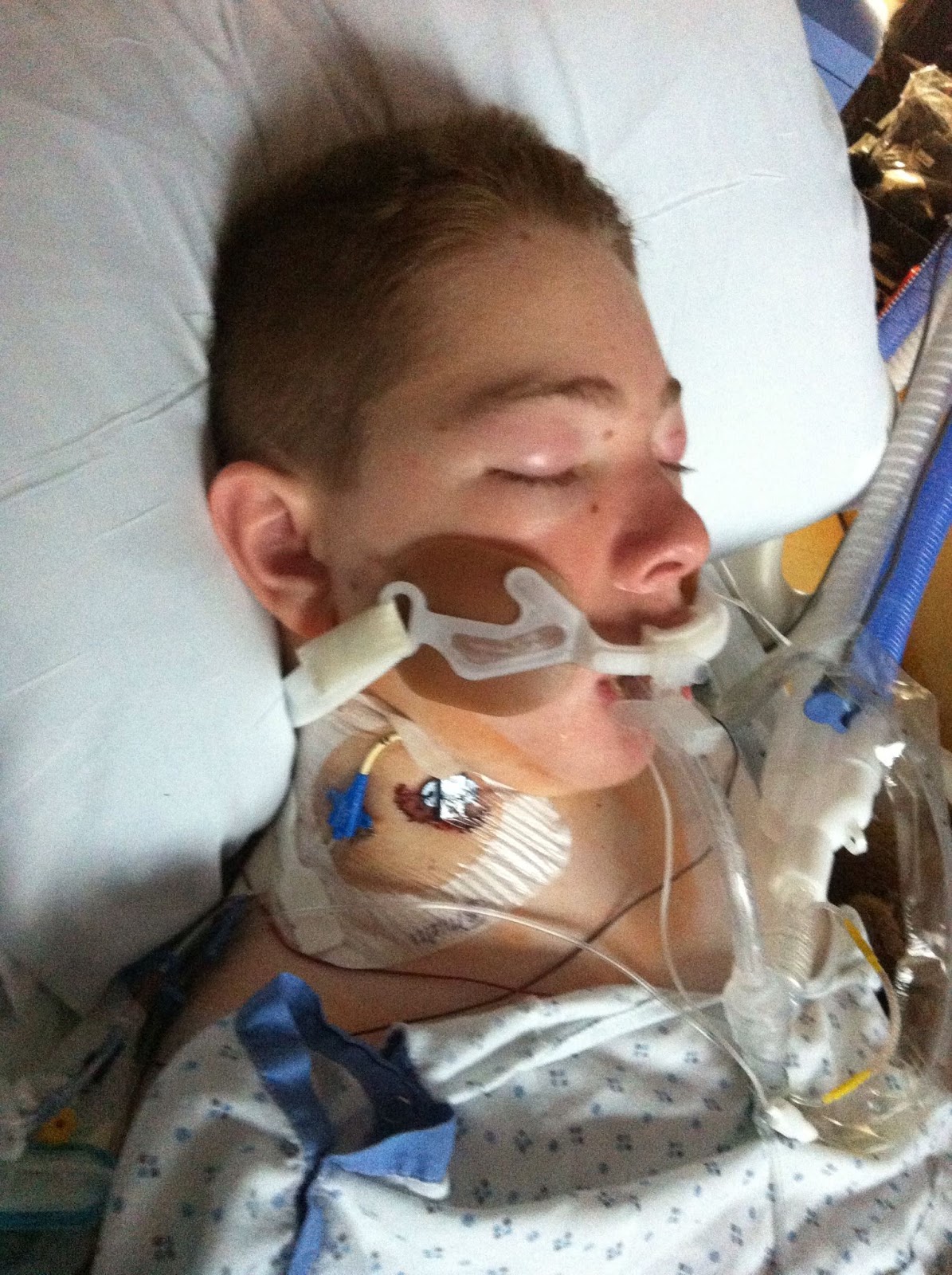 Raising Daniel Hasselberger, a journey with Polymicrogyria: Spinal ...