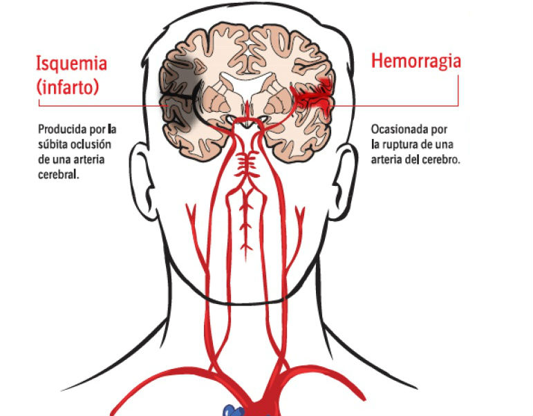 SALUD CARDIOVASCULAR: ¿QUÉ ES EL ICTUS?, ¿CUÁLES SON SUS CAUSAS?
