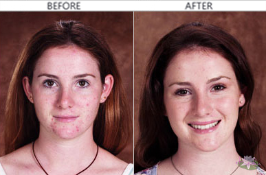 how people getting rid of acne in a week using this simple trick