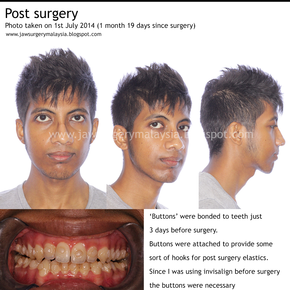 Double Jaw Surgery [From Malaysia to Singapore]: Videos/Images