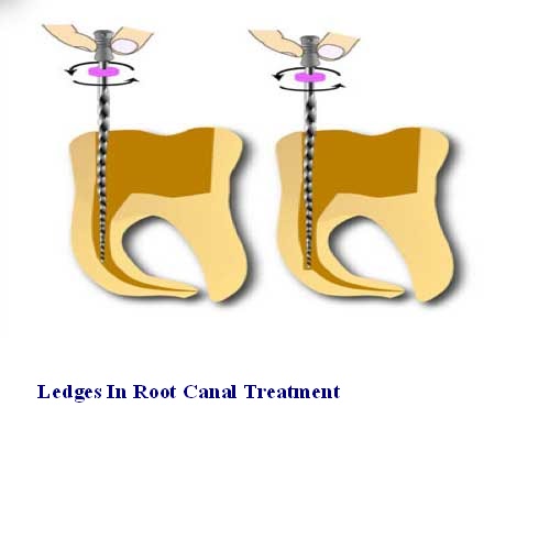 Ledges ~ Dental Vision