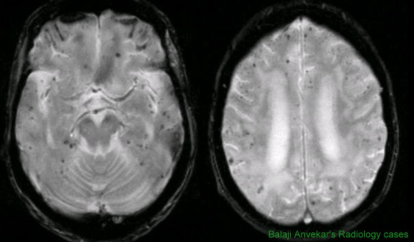 Dr Balaji Anvekar FRCR: Cerebral Microbleeds