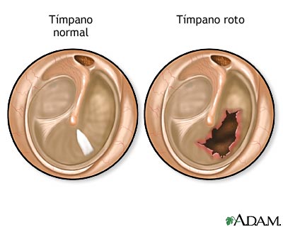Emergency Team : Cuidados en Timpanoplastia
